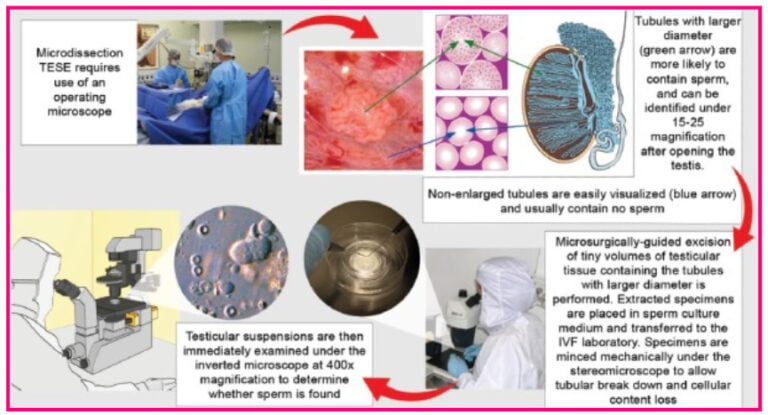 Surgical Sperm Retrieval Service | Surgical Treatment and Information ...
